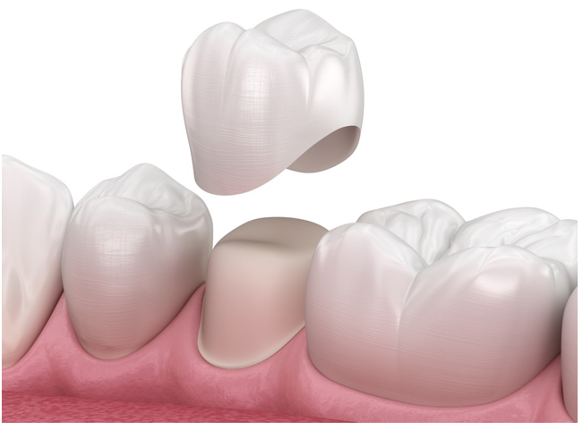 Tandkrona - Tandvårdsteamet Avenyn